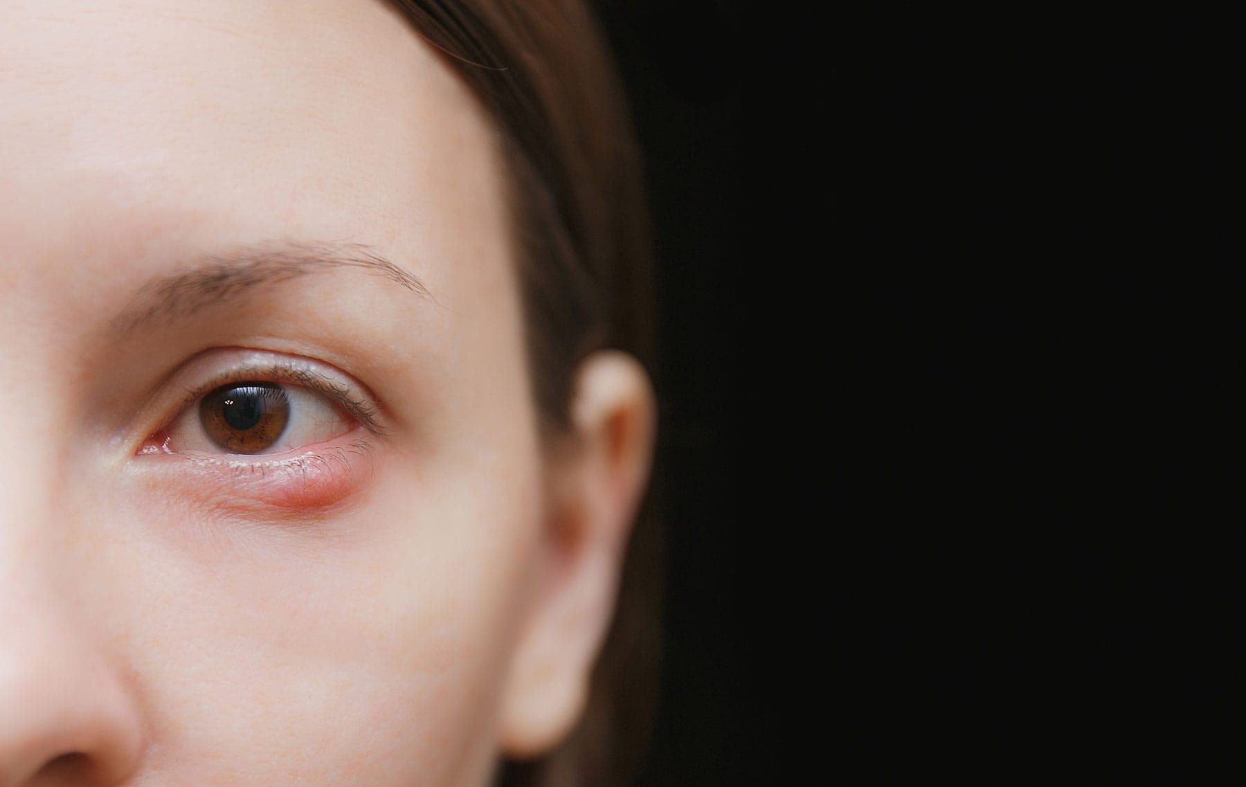 Blepharitis Specialist NYC | Eyelid Inflammation Treatments Downtown ...