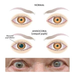 Anisocoria Treatment NYC | Adie Syndrome Treatment Downtown Manhattan