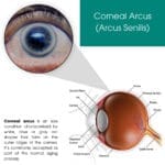 Corneal Arcus Treatment Downtown Manhattan | Arcus Senilis Specialist ...