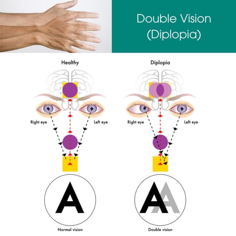 Diplopia Treatment NYC | Double Vision Specialist in Downtown Manhattan