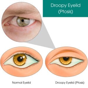 Droopy Eyelid Treatment Nyc Ptosis Specialist In Downtown Manhattan