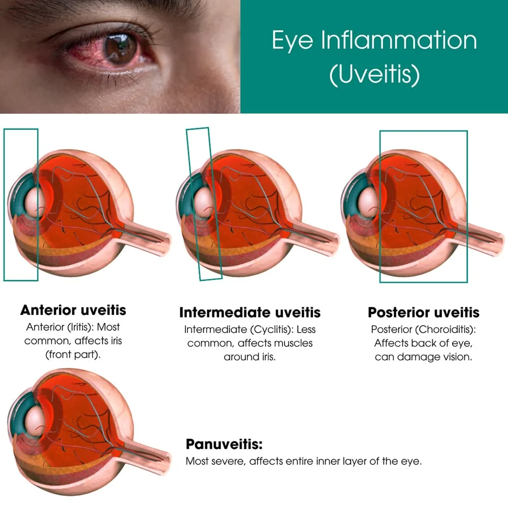 Uveitis Causes Symptoms And Treatment Uveitis Treatment Market Size,