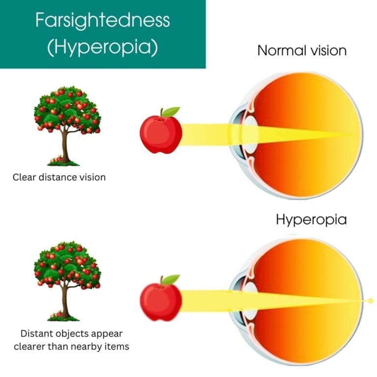 Farsightedness Treatment NYC | Hyperopia Treatment in Downtown Manhattan
