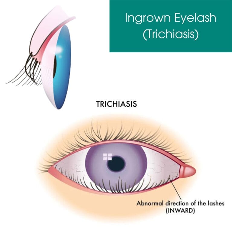 Remove Ingrown Eyelash NYC | Trichiasis Treatment Downtown Manhattan