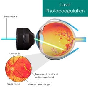 Laser Photocoagulation NYC | Retina Laser Surgery Downtown Manhattan