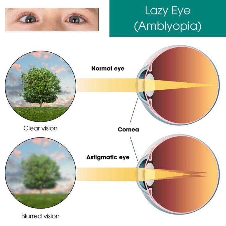 Lazy Eye Treatment NYC | Amblyopia Specialist Downtown Manhattan