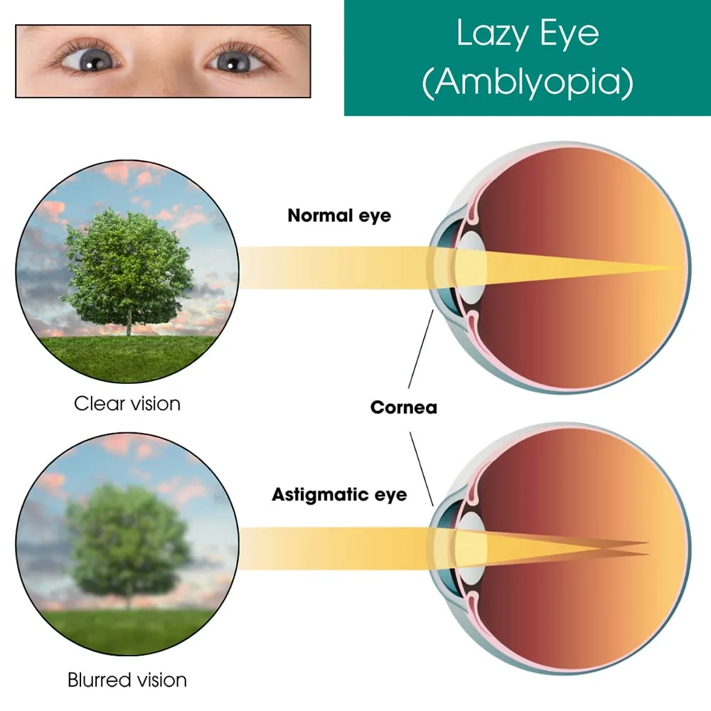 Lazy Eye Treatment NYC | Amblyopia Specialist Downtown Manhattan