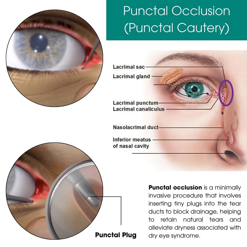 Punctal Occlusion (Punctal Cautery) NYC | Cautery Surgery Downtown ...