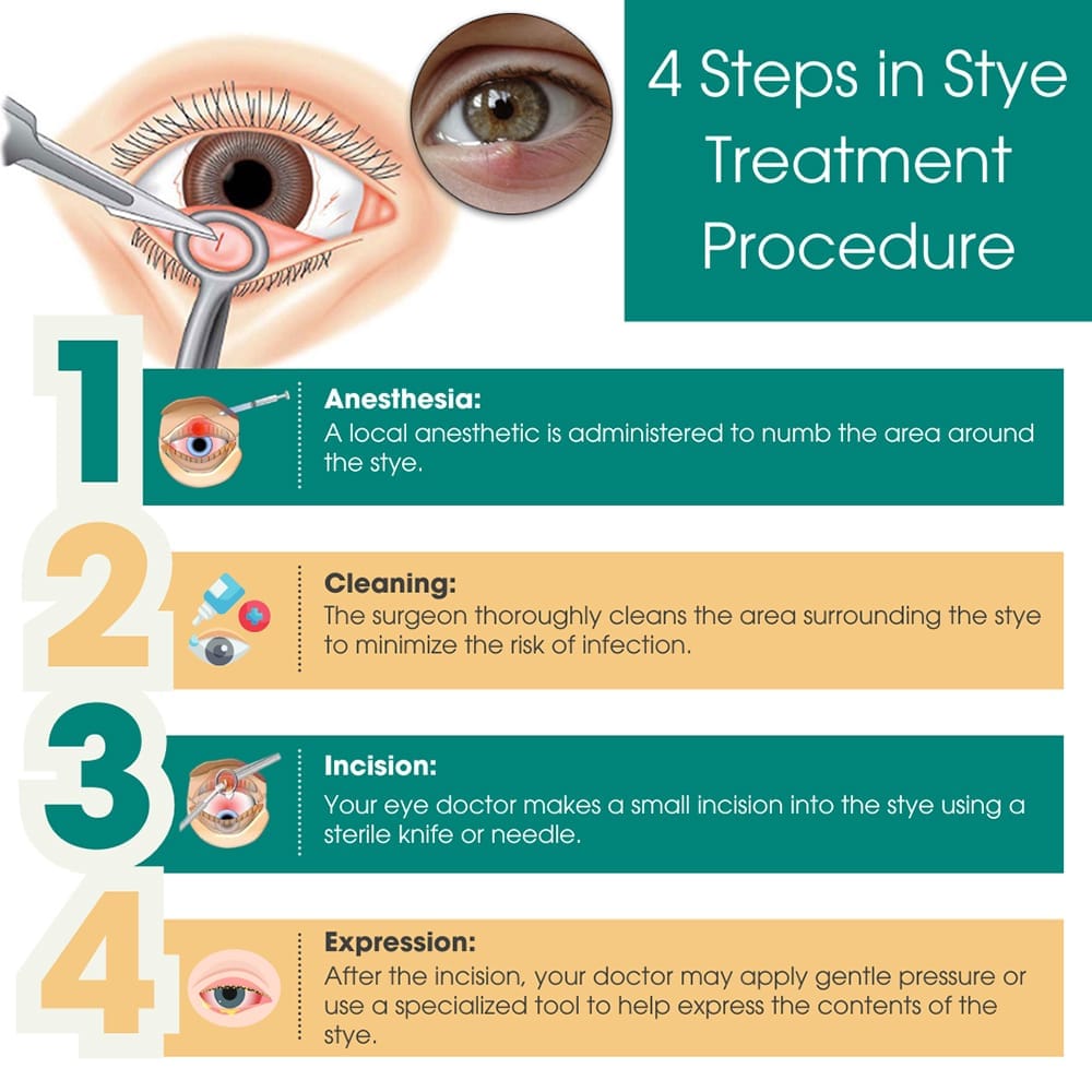 Eye Stye Removal Treatment NYC Stye Surgery Downtown Manhattan Eye Stye Removal Treatment NYC Stye Surgery Downtown Manhattan
