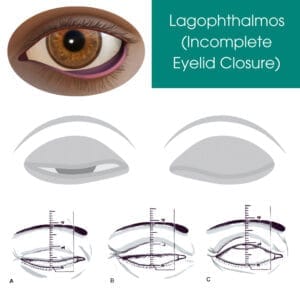 Lagophthalmos Treatment NYC | Incomplete Eyelid Closure Downtown Manhattan