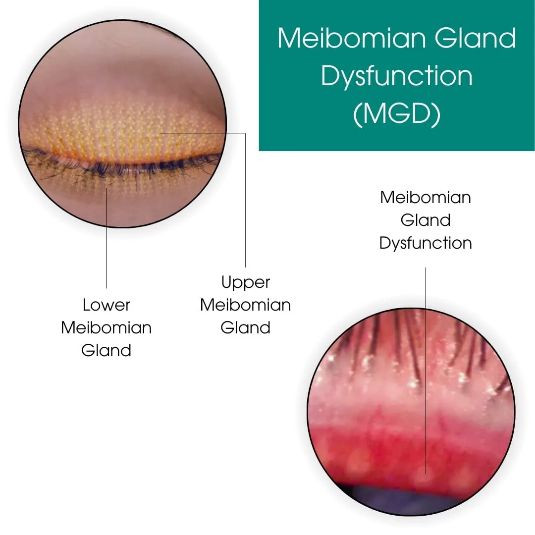 Meibomian Gland Dysfunction Treatment Tools Of The Trade: Current