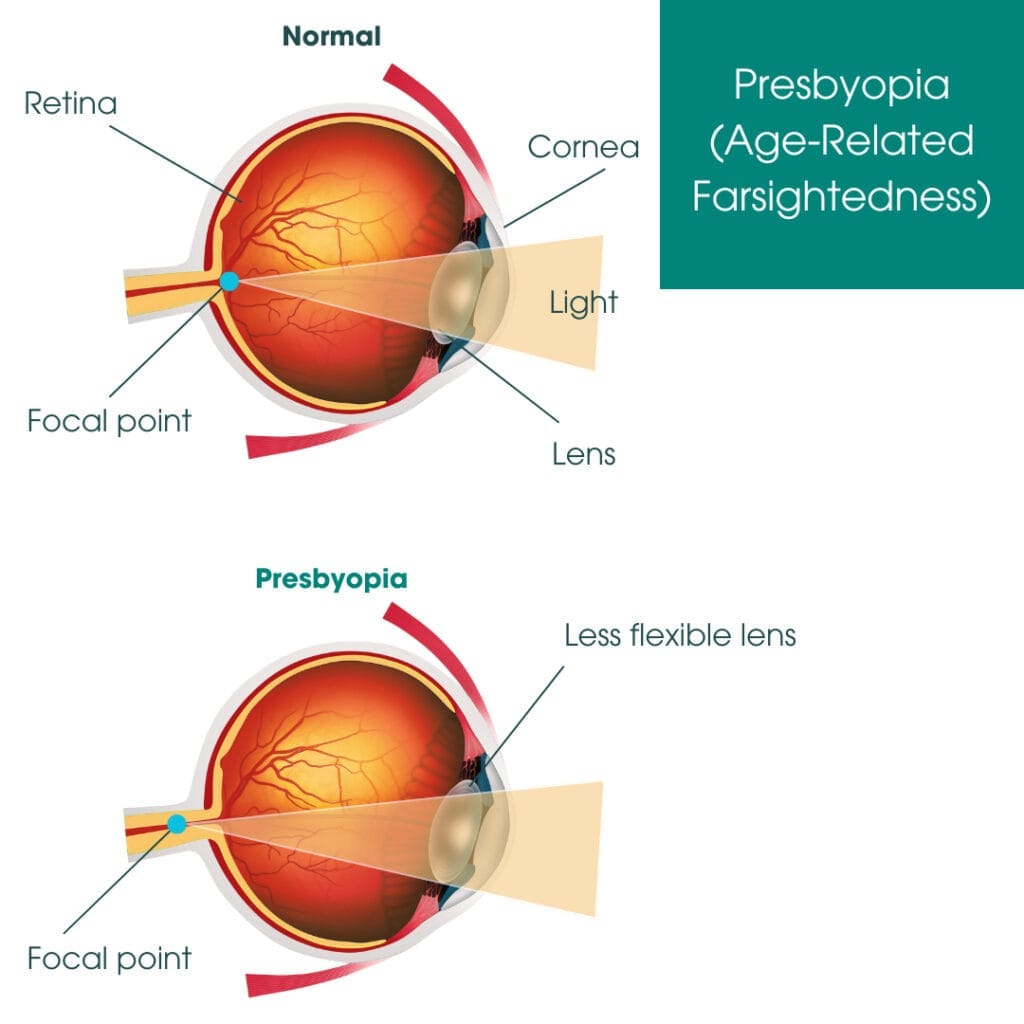Presbyopia Treatment NYC | Age-Related Farsightedness Treatment in ...