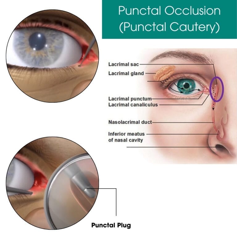 Punctal Occlusion (Punctal Cautery) NYC | Cautery Surgery Downtown ...